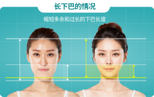 V-line下颌角手术 | id整形医院